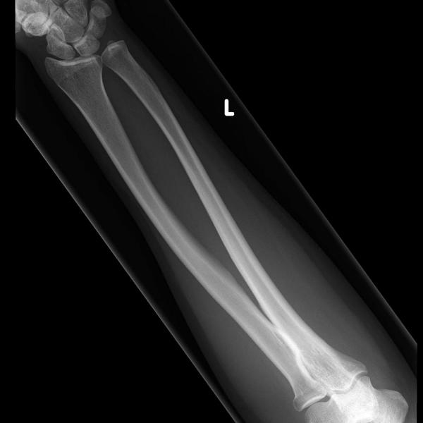 Rntgenbild Des Unterarms Apansicht Anteroposteriore Röntgenphantom